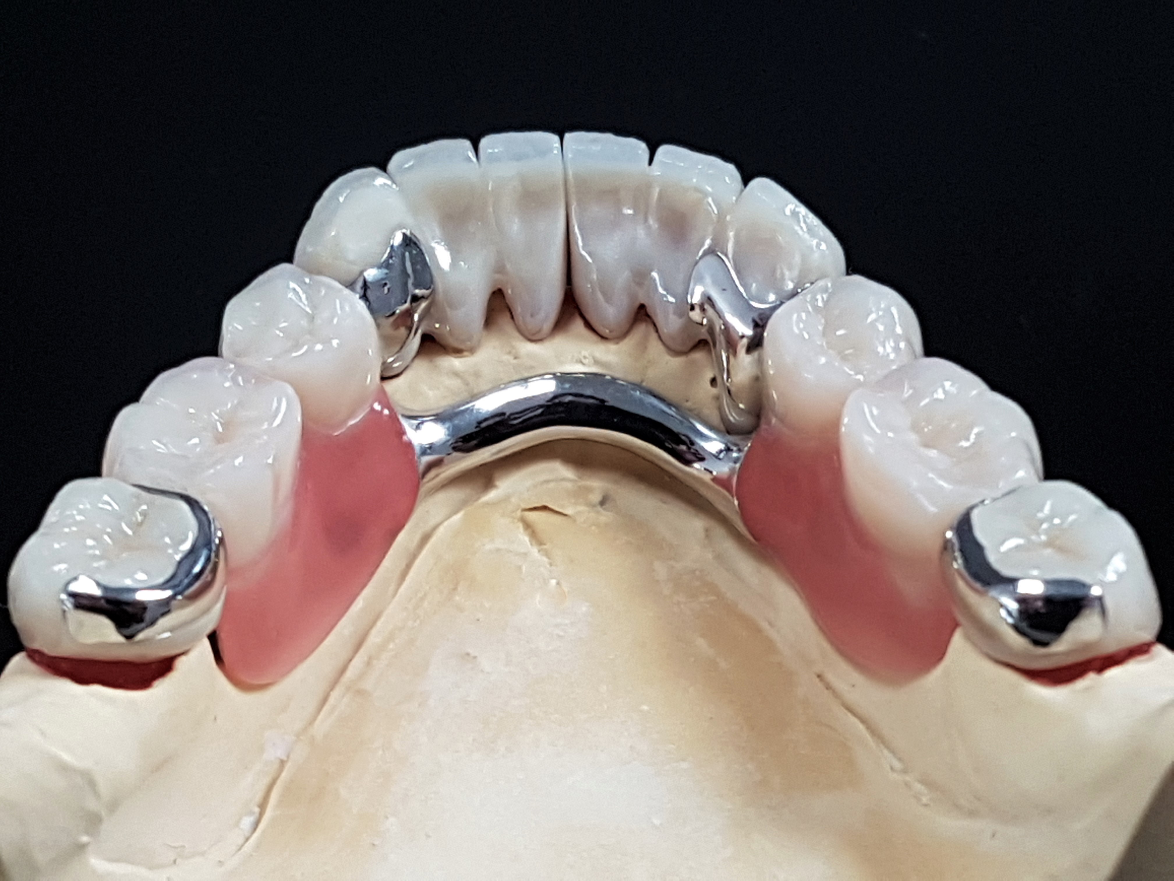 Lipp Zahntechnik - Geschiebeprothetik