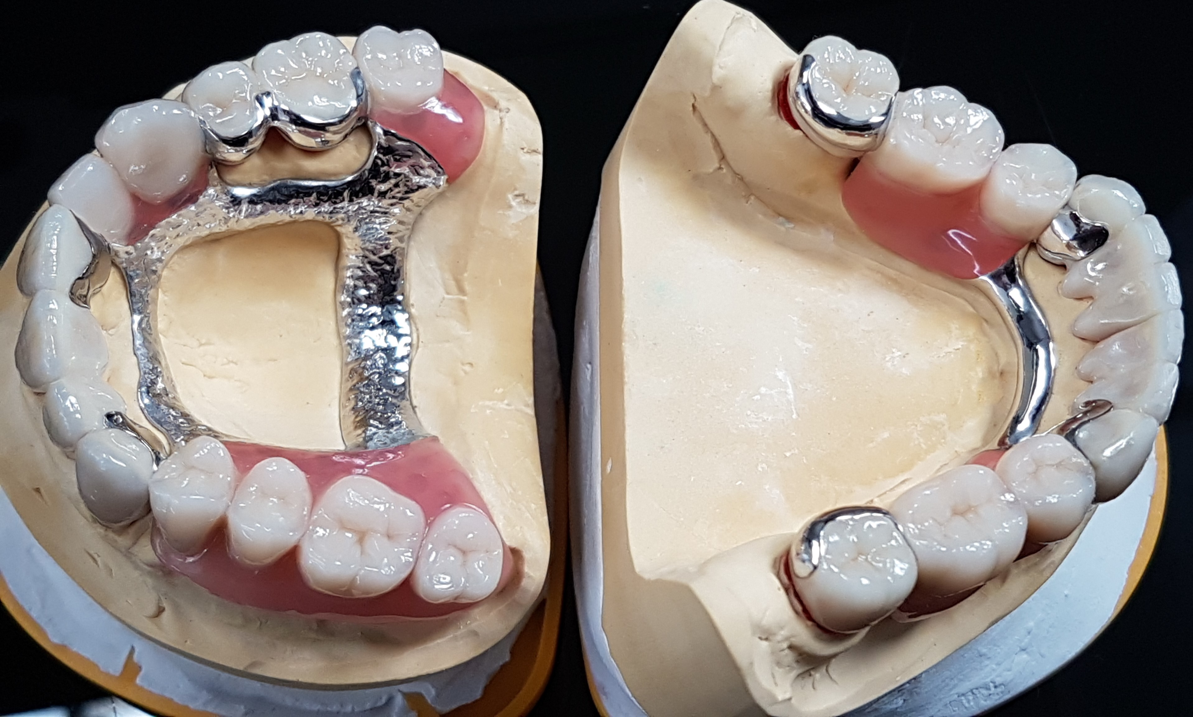 Lipp Zahntechnik - Geschiebeprothetik