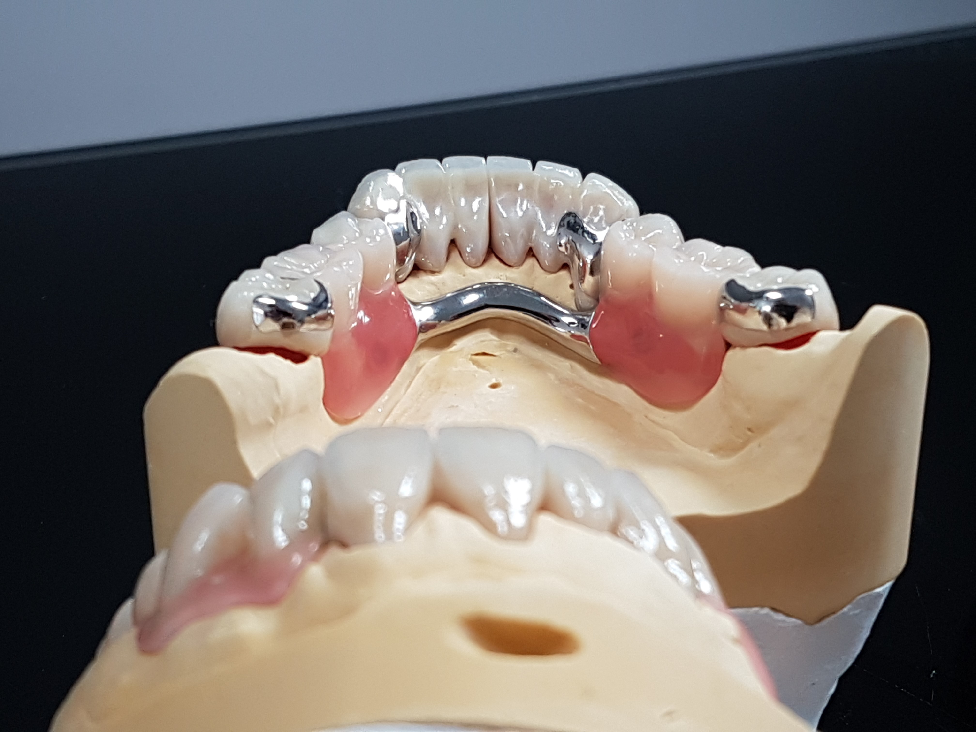 Lipp Zahntechnik - Geschiebeprothetik