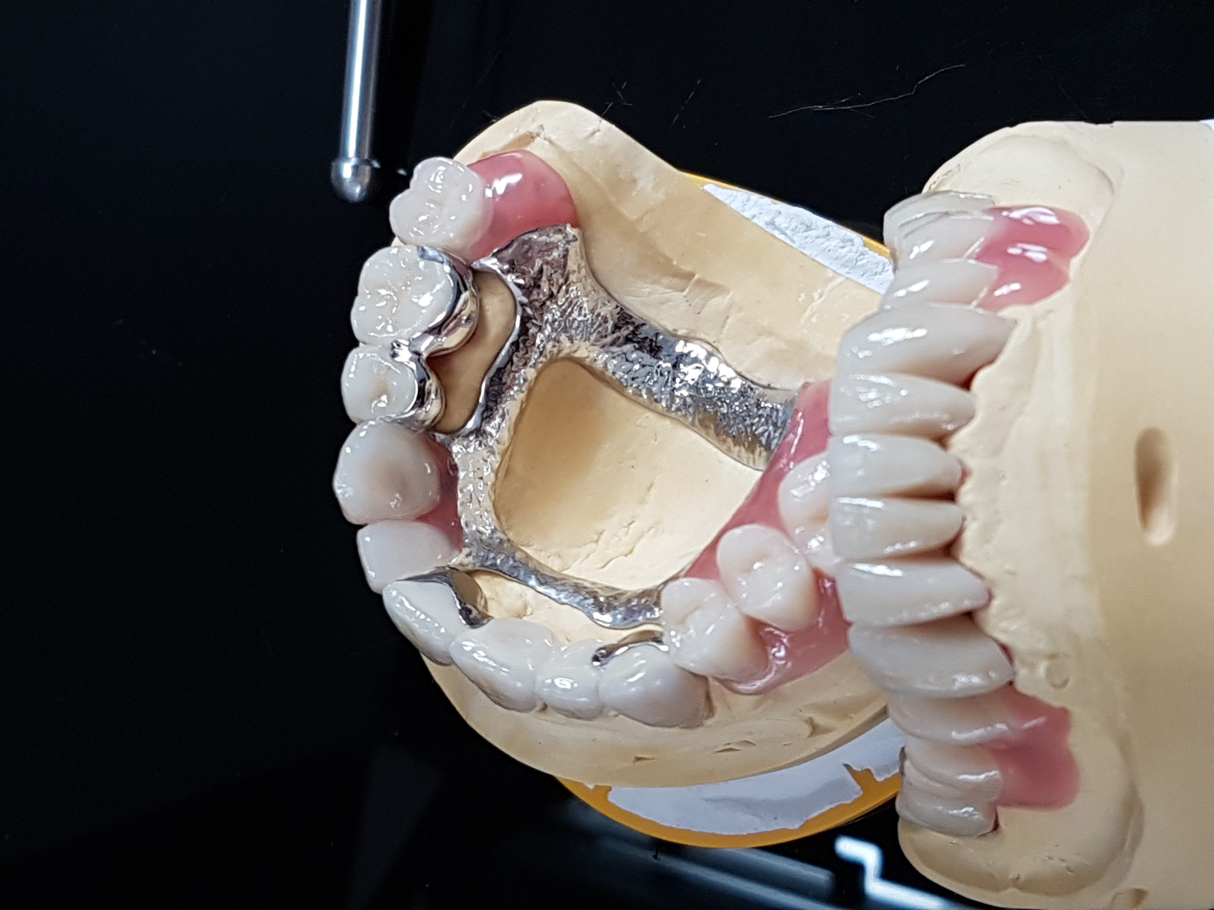 Lipp Zahntechnik - Geschiebeprothetik