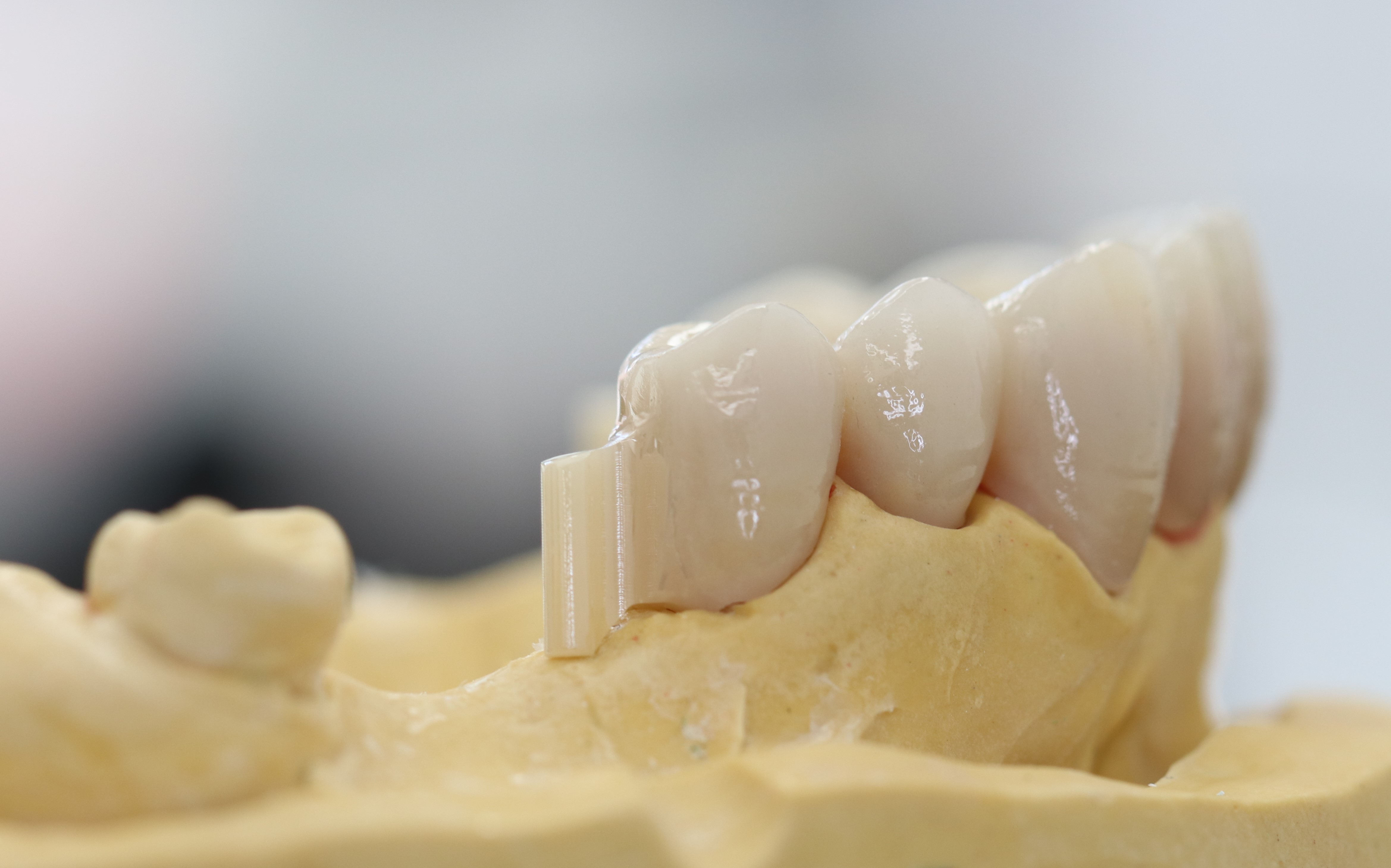 Lipp Zahntechnik - Geschiebeprothetik