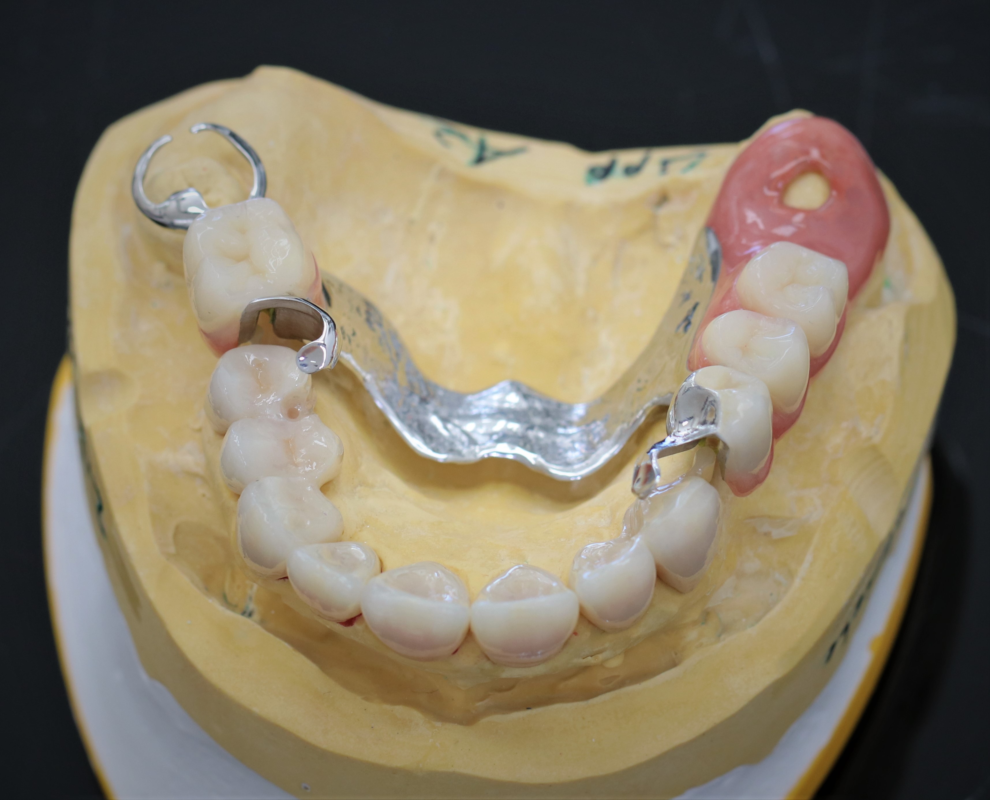 Lipp Zahntechnik - Geschiebeprothetik