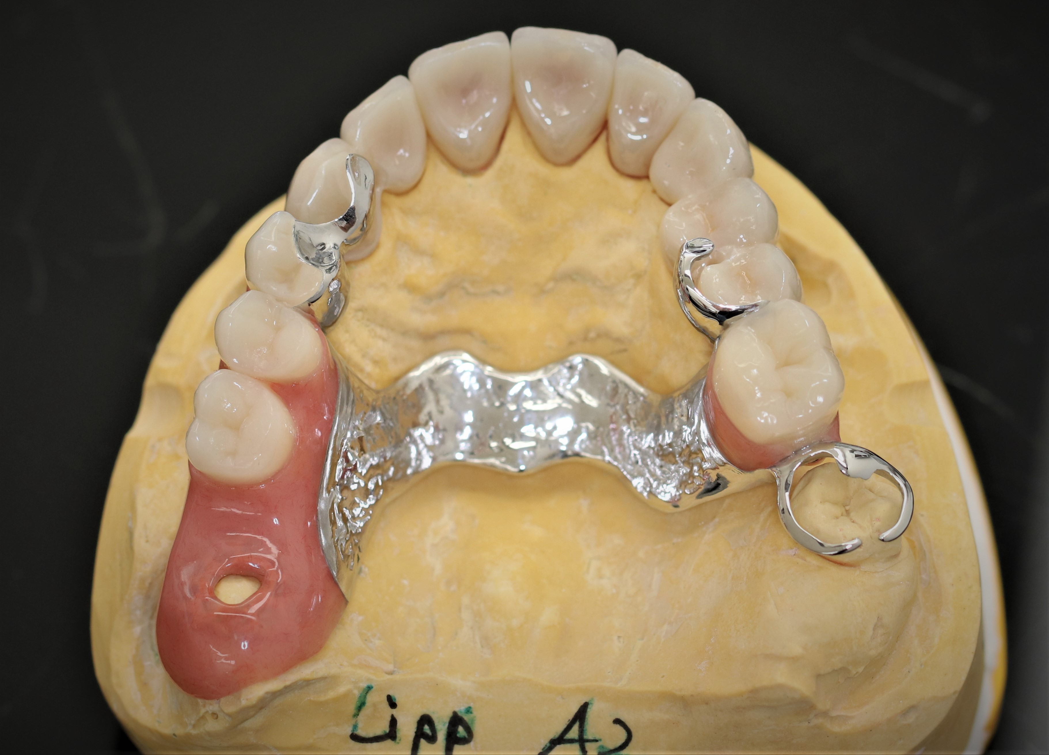 Lipp Zahntechnik - Geschiebeprothetik