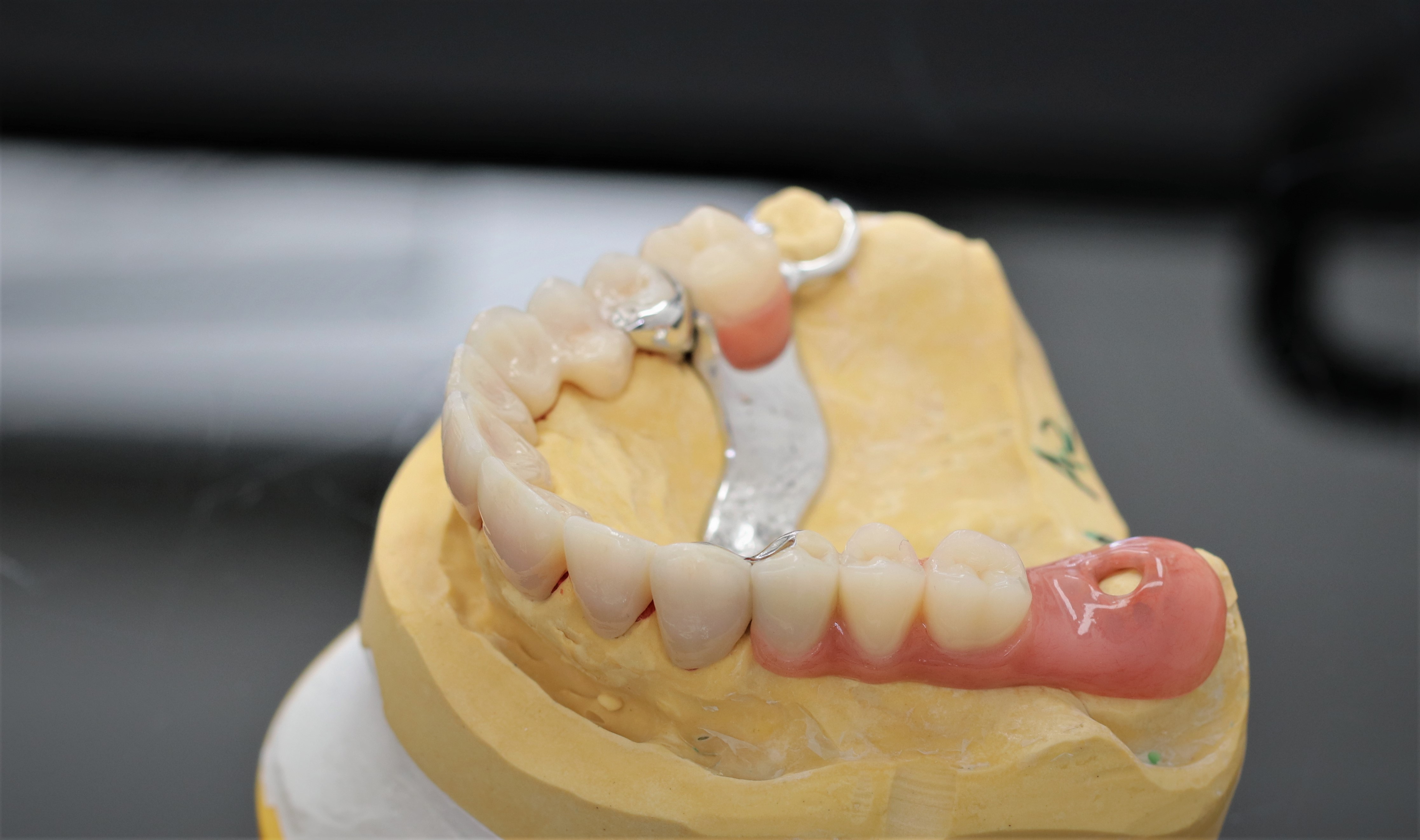 Lipp Zahntechnik - Geschiebeprothetik