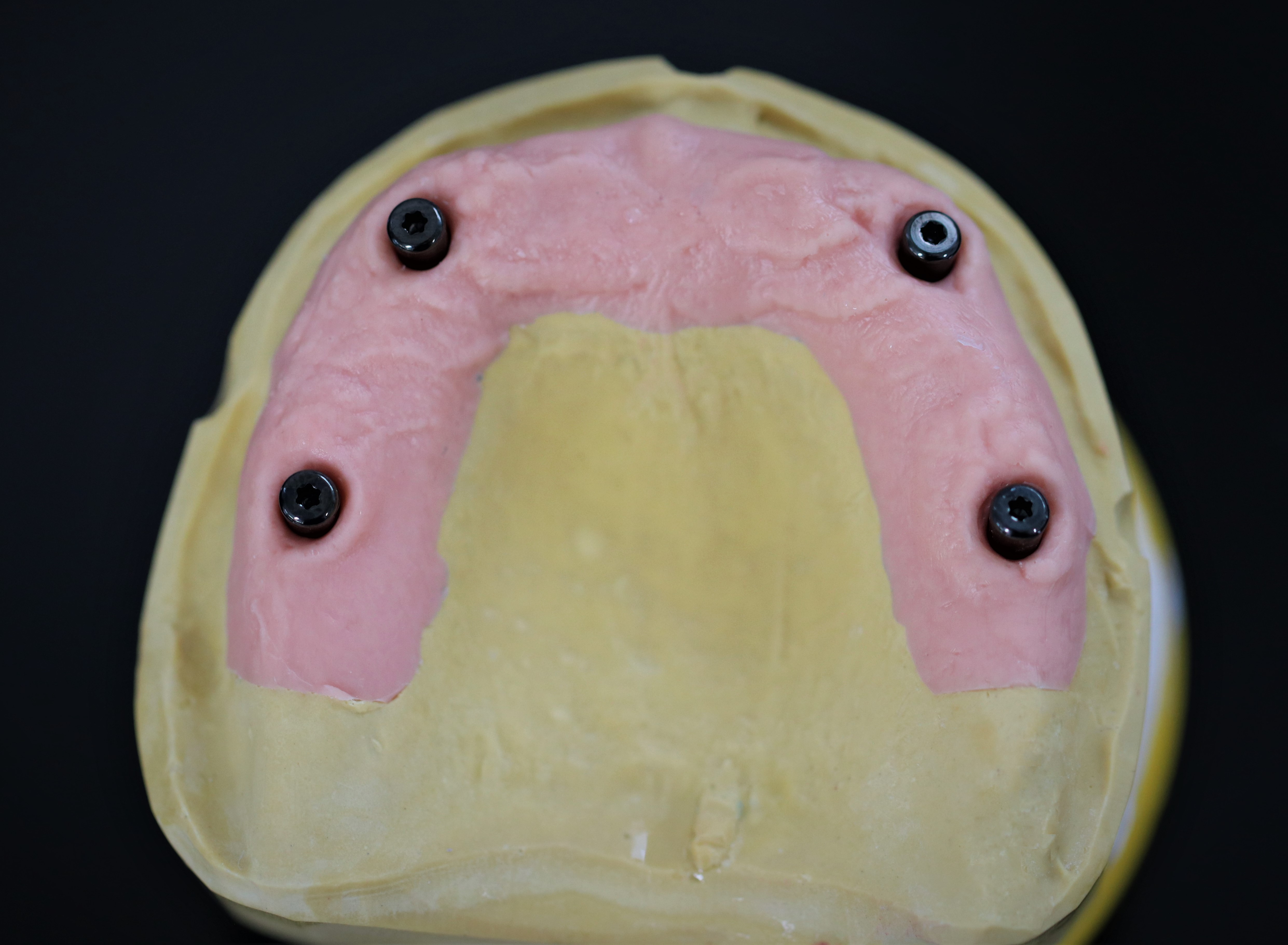 Lipp Zahntechnik - Locatoren