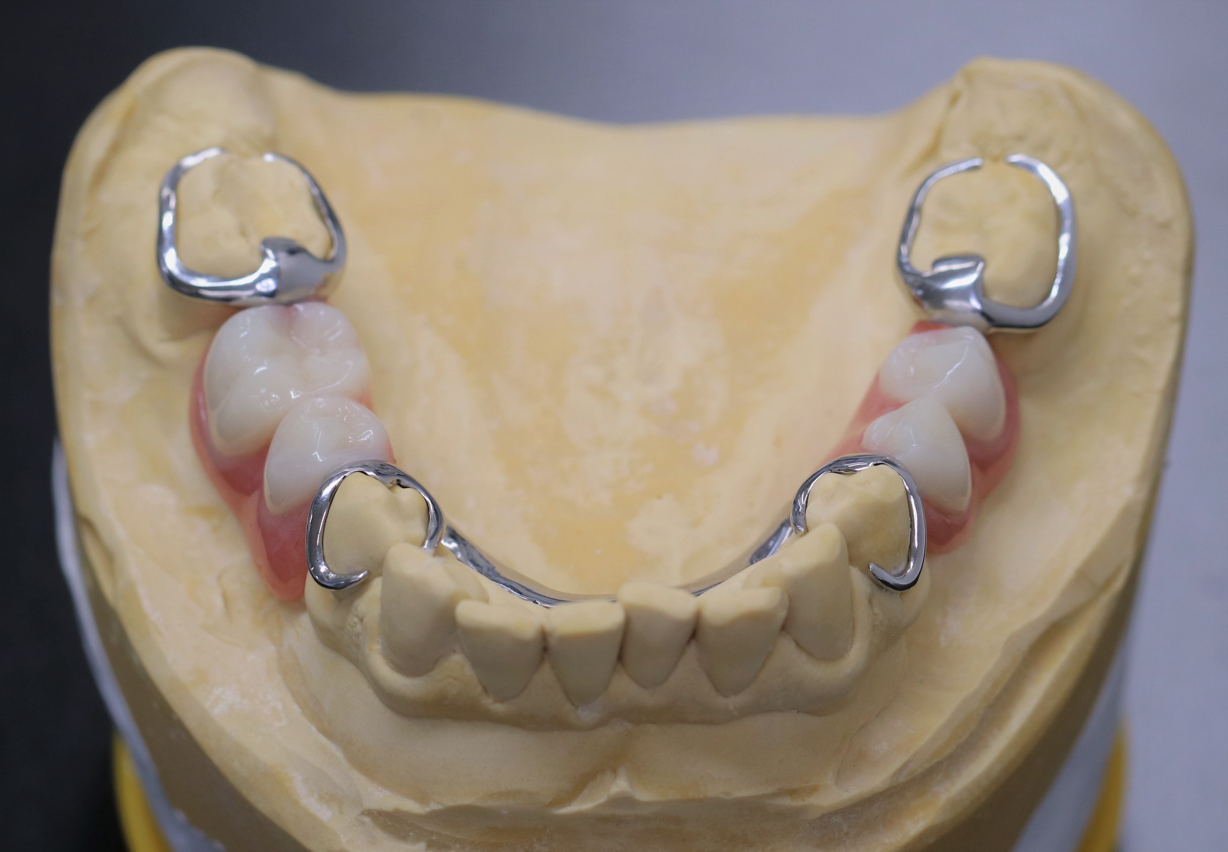 Lipp Zahntechnik - Modellguß