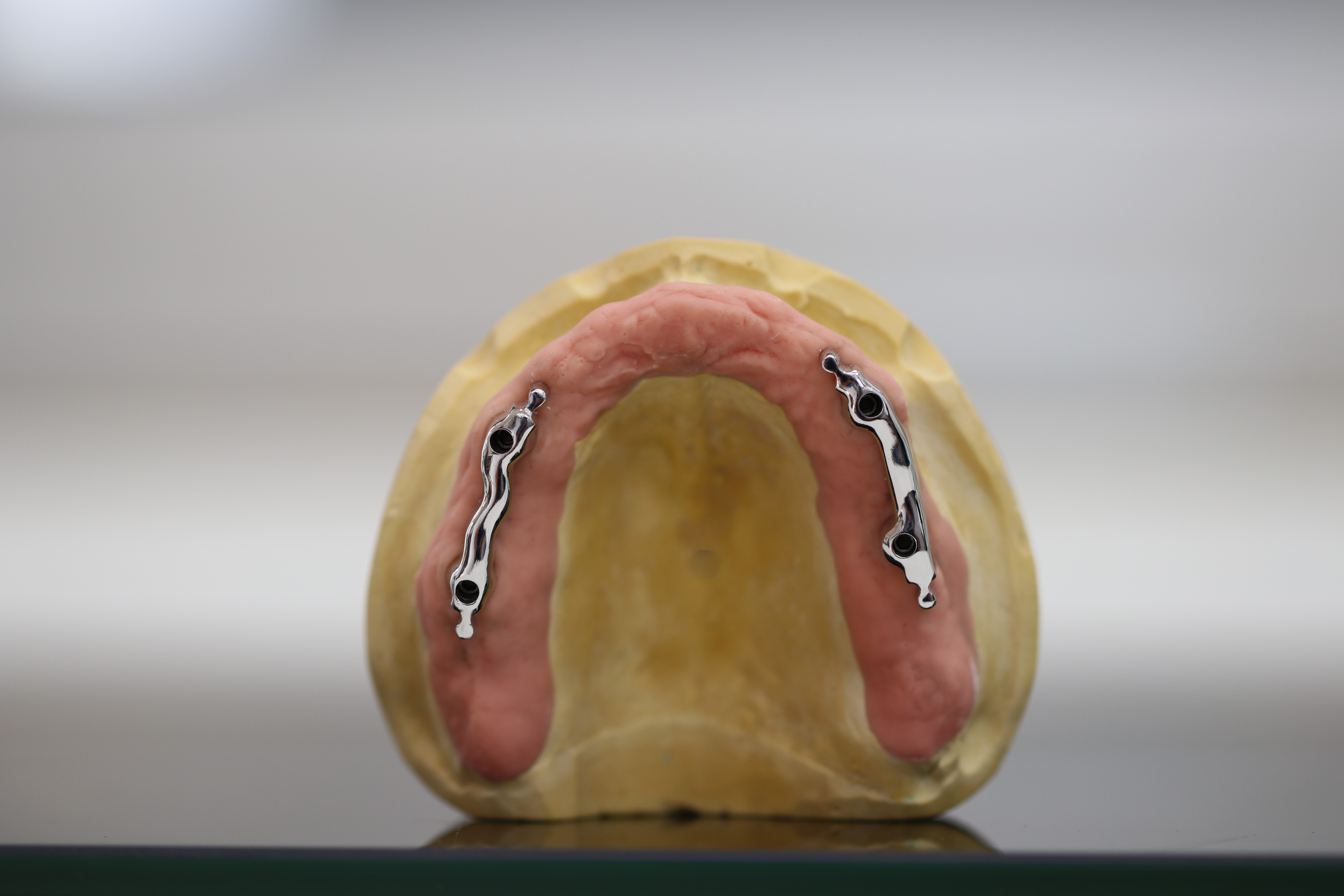 Lipp Zahntechnik - Stegarbeiten