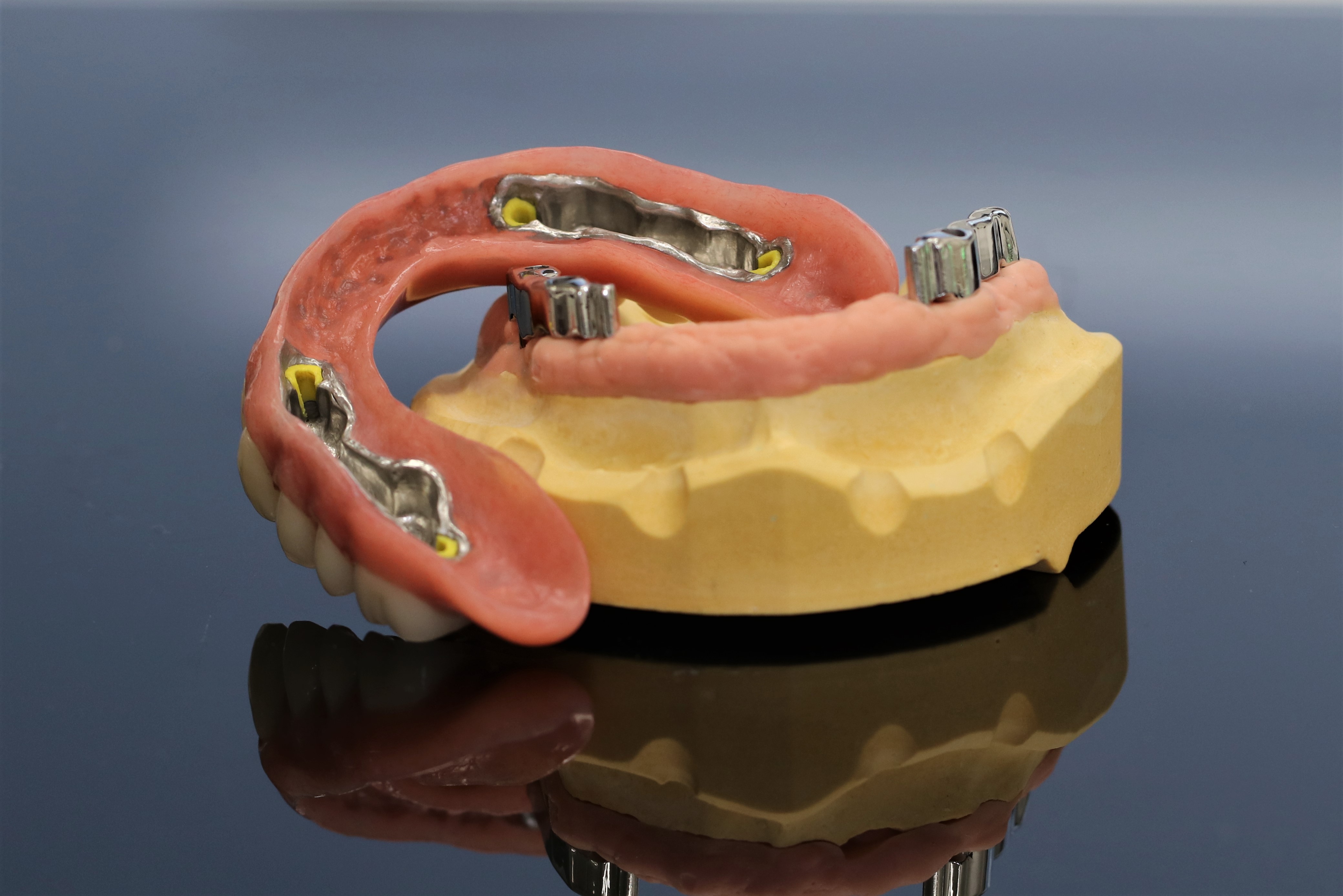 Lipp Zahntechnik - Stegarbeiten